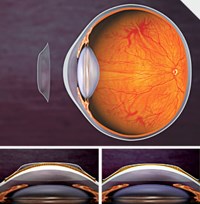 Corneal Refractive Therapy (CRT) | Summit Vision Care